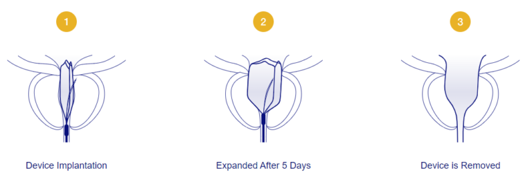 iTind Procedure | The Urology Group